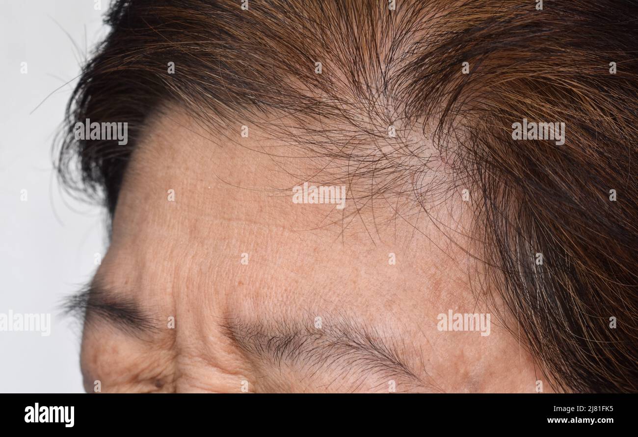 Skin creases or wrinkles at forehead of Southeast Asian, Myanmar or ...