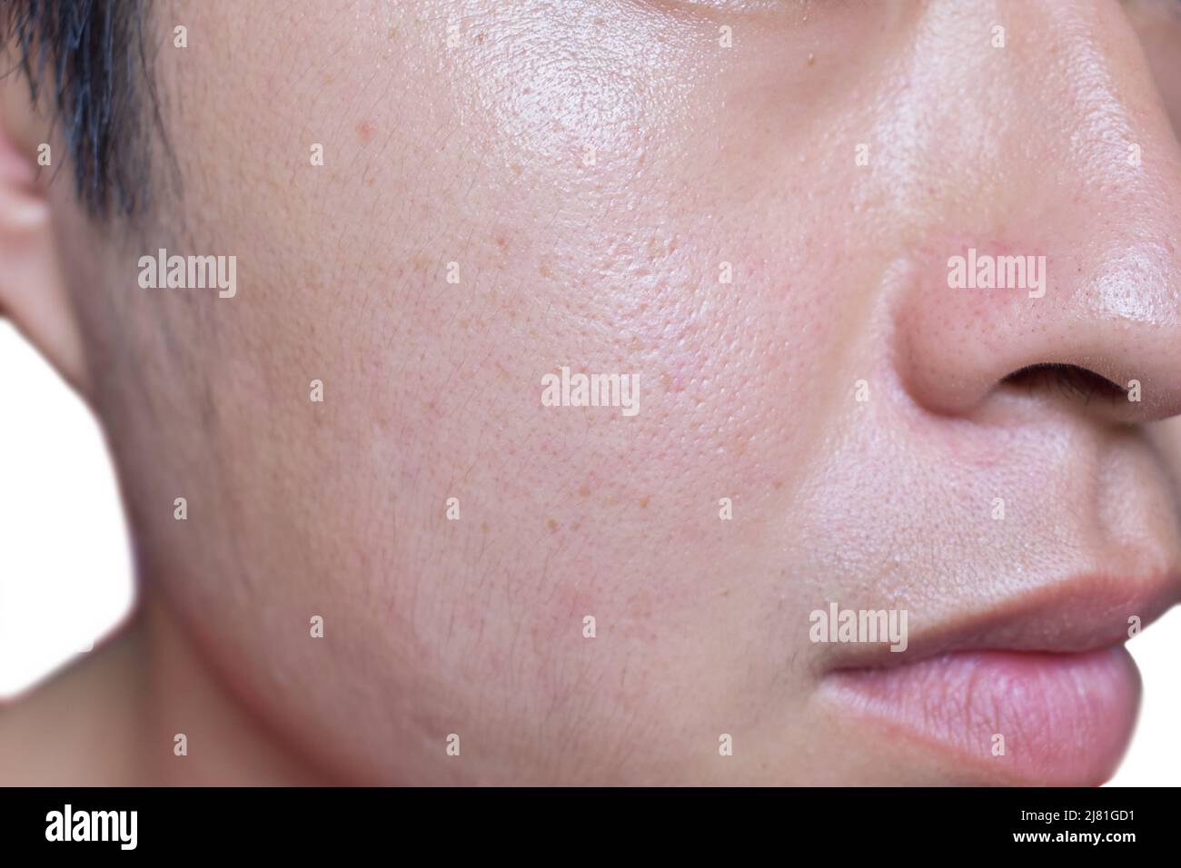 Seborrhoea hair hi-res stock photography and images - Alamy