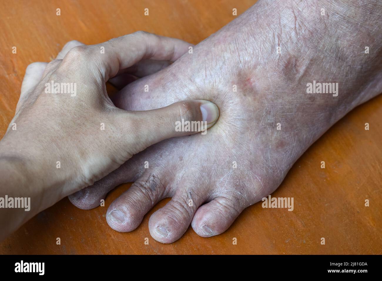 Pitting Edema Pitting Oedema | Signs MedSchool
