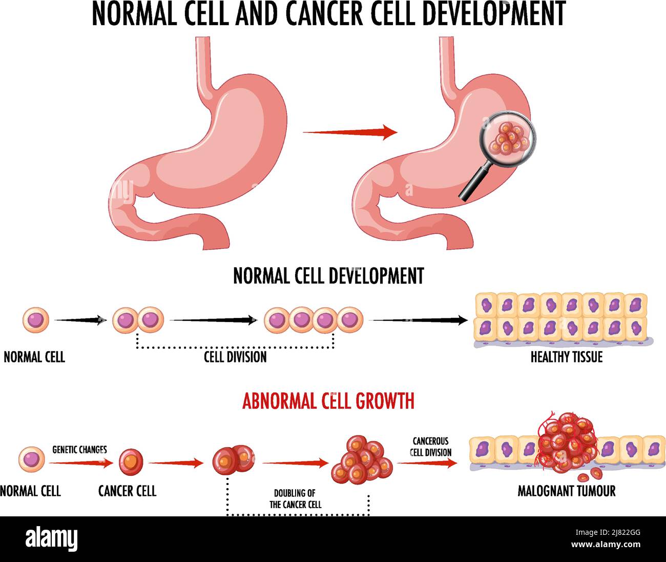 Diagram showing cancer development process illustration Stock Vector ...