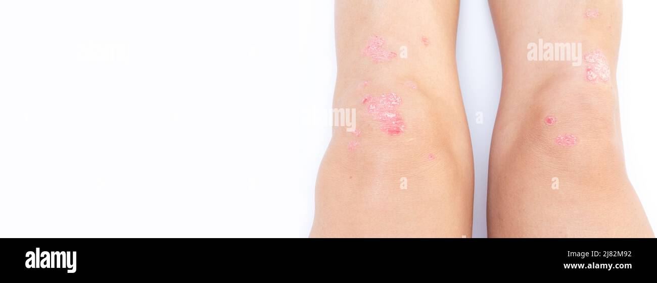 Knee joint effusion (water on knee) Acute psoriatic arthritis ...