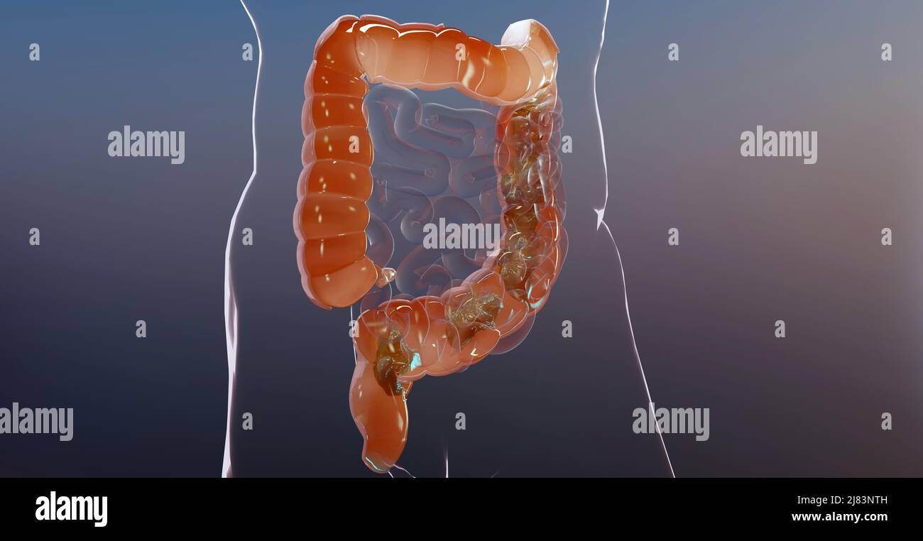 Large intestine clean hi-res stock photography and images - Alamy
