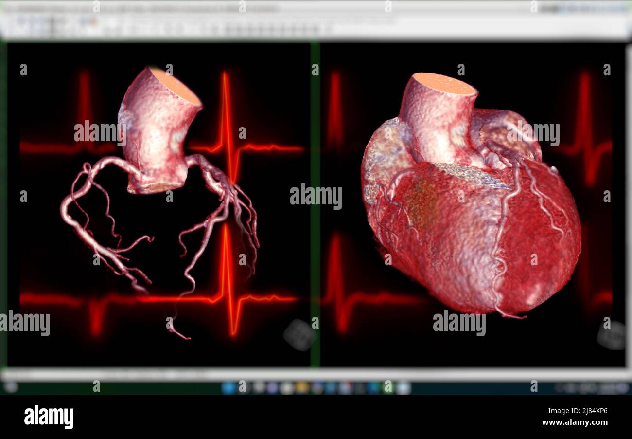 CTA Coronary artery 3D rendering image on the screen for diagnosis of ...