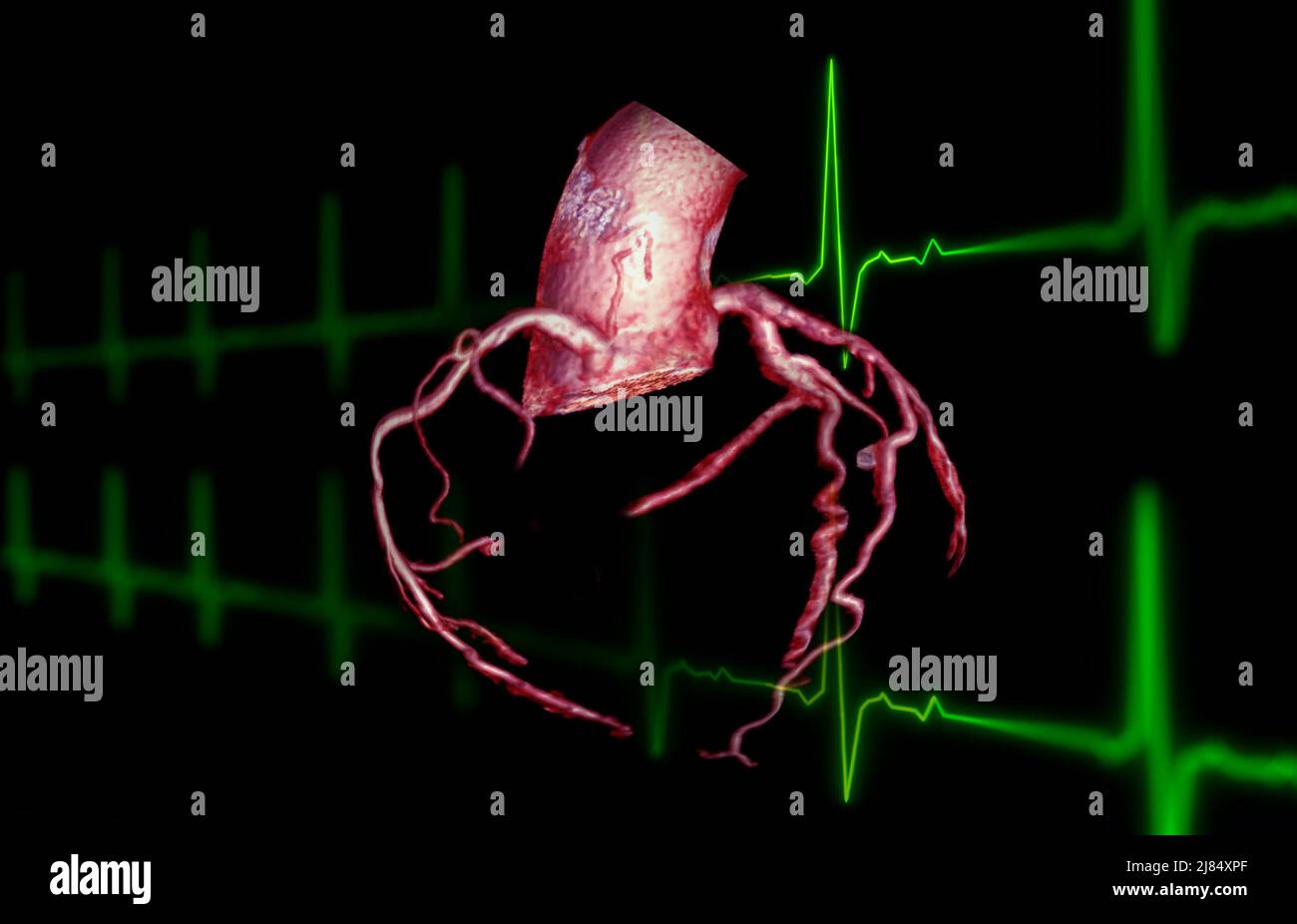 CTA Coronary artery 3D rendering image on the screen for diagnosis of ...