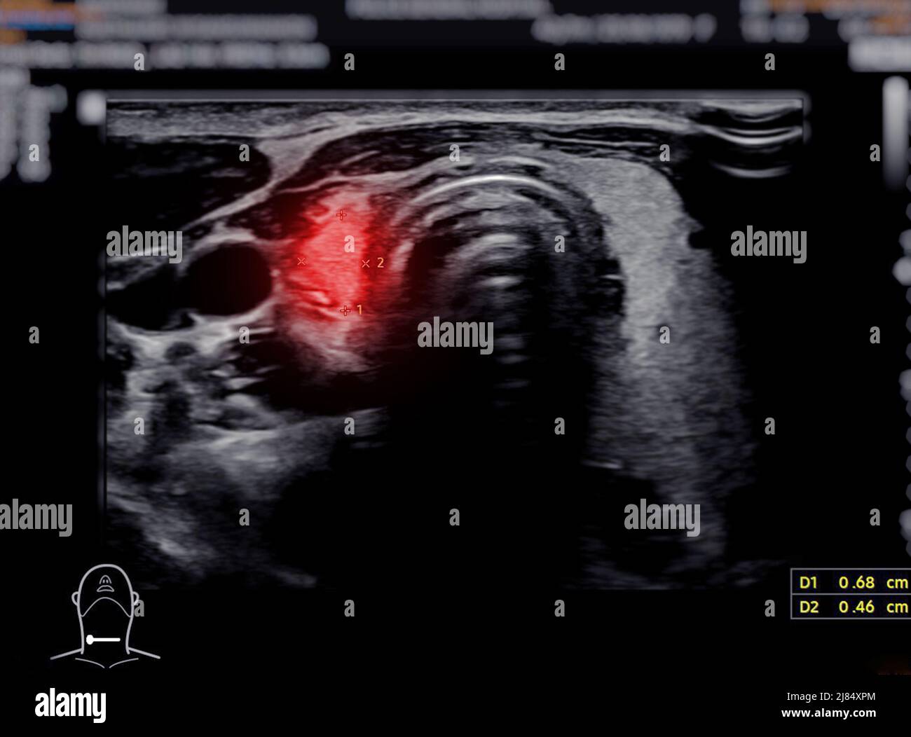 Ultrasonography Of Thyroid Gland For Diagnostics Of The Thyroid Gland