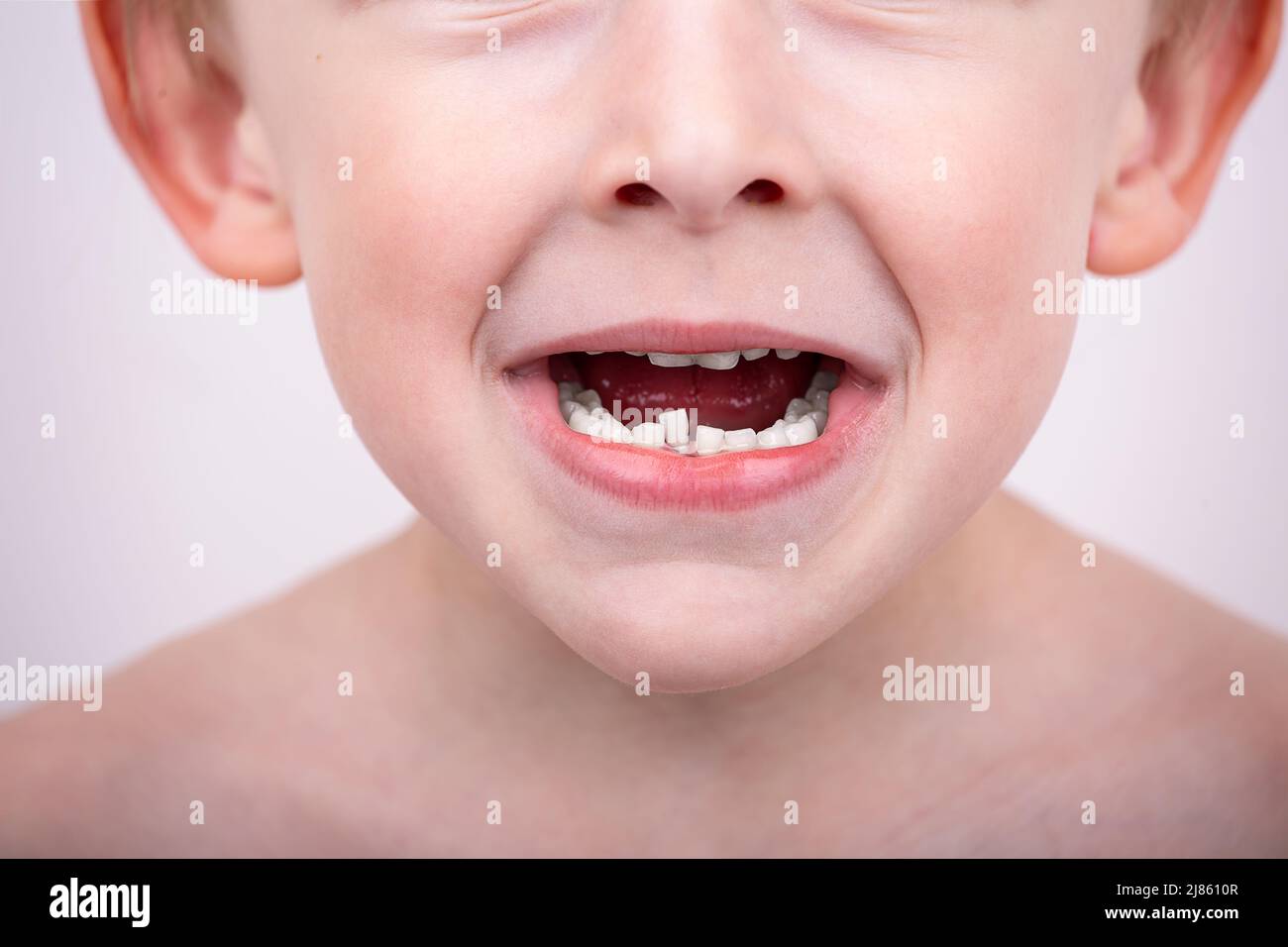 The first baby tooth, ready to fall out Stock Photo - Alamy