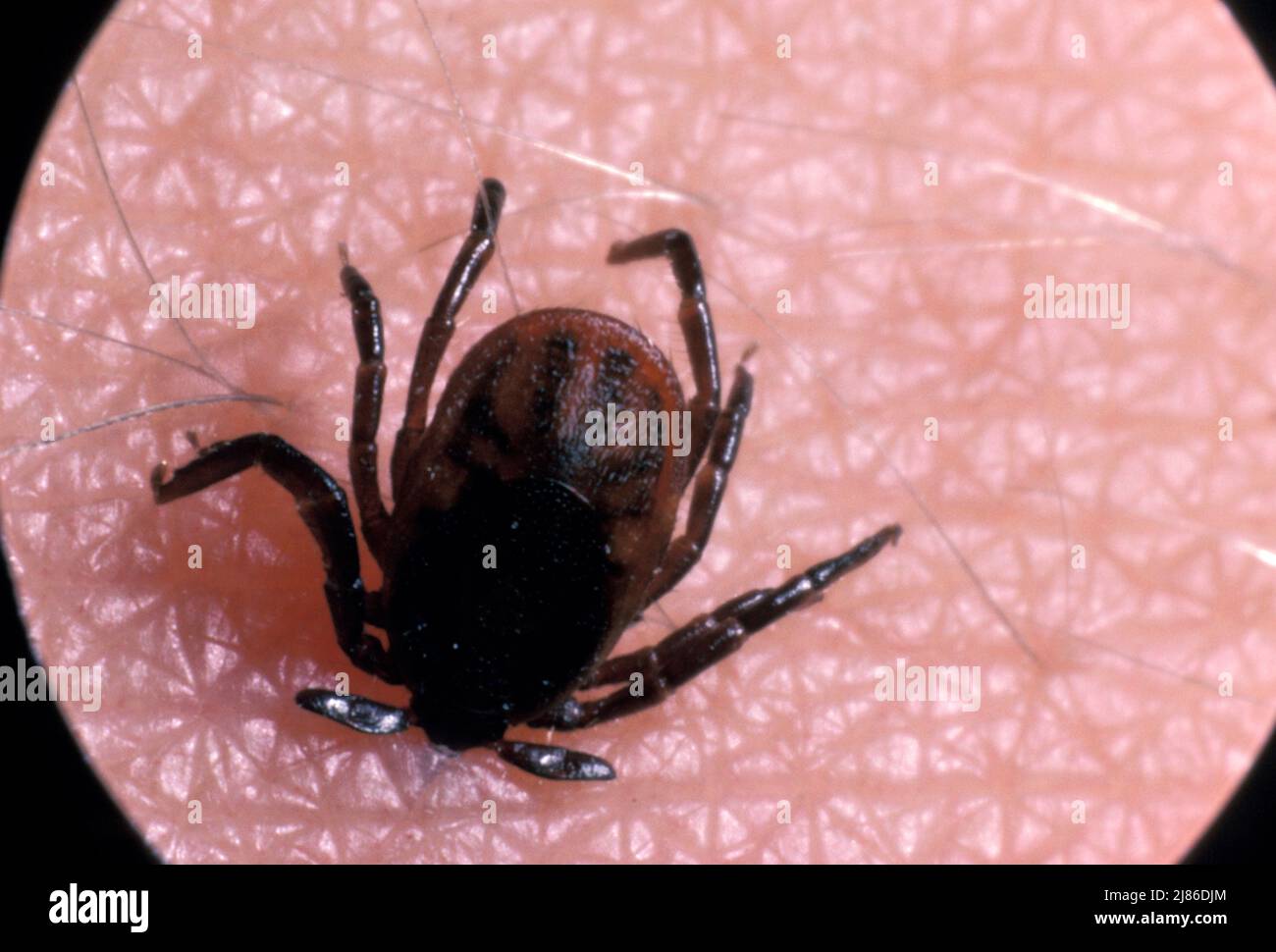 Tick parasitizing a human being, France Stock Photo - Alamy