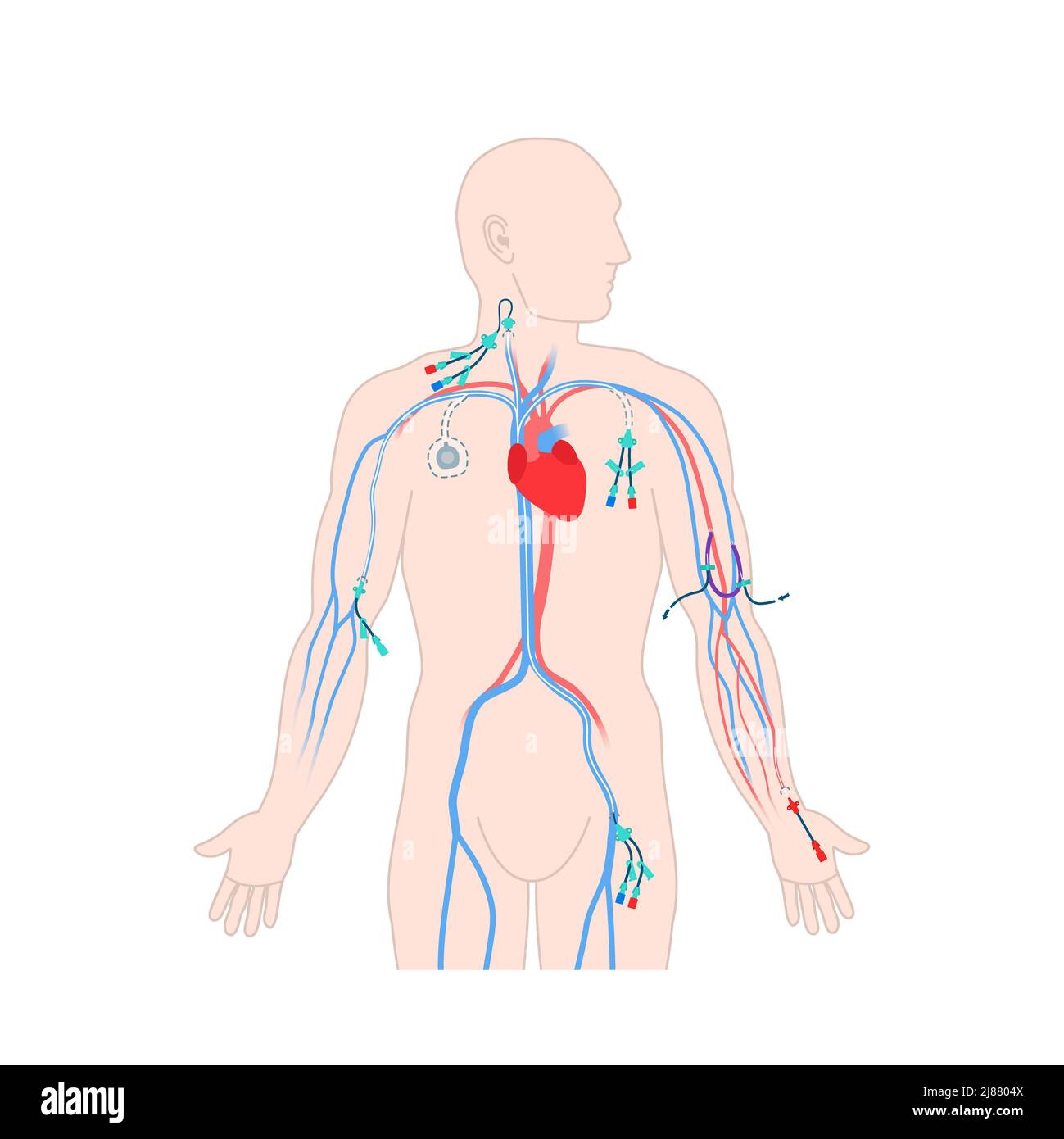 Central venous catheter, illustration Stock Photo - Alamy