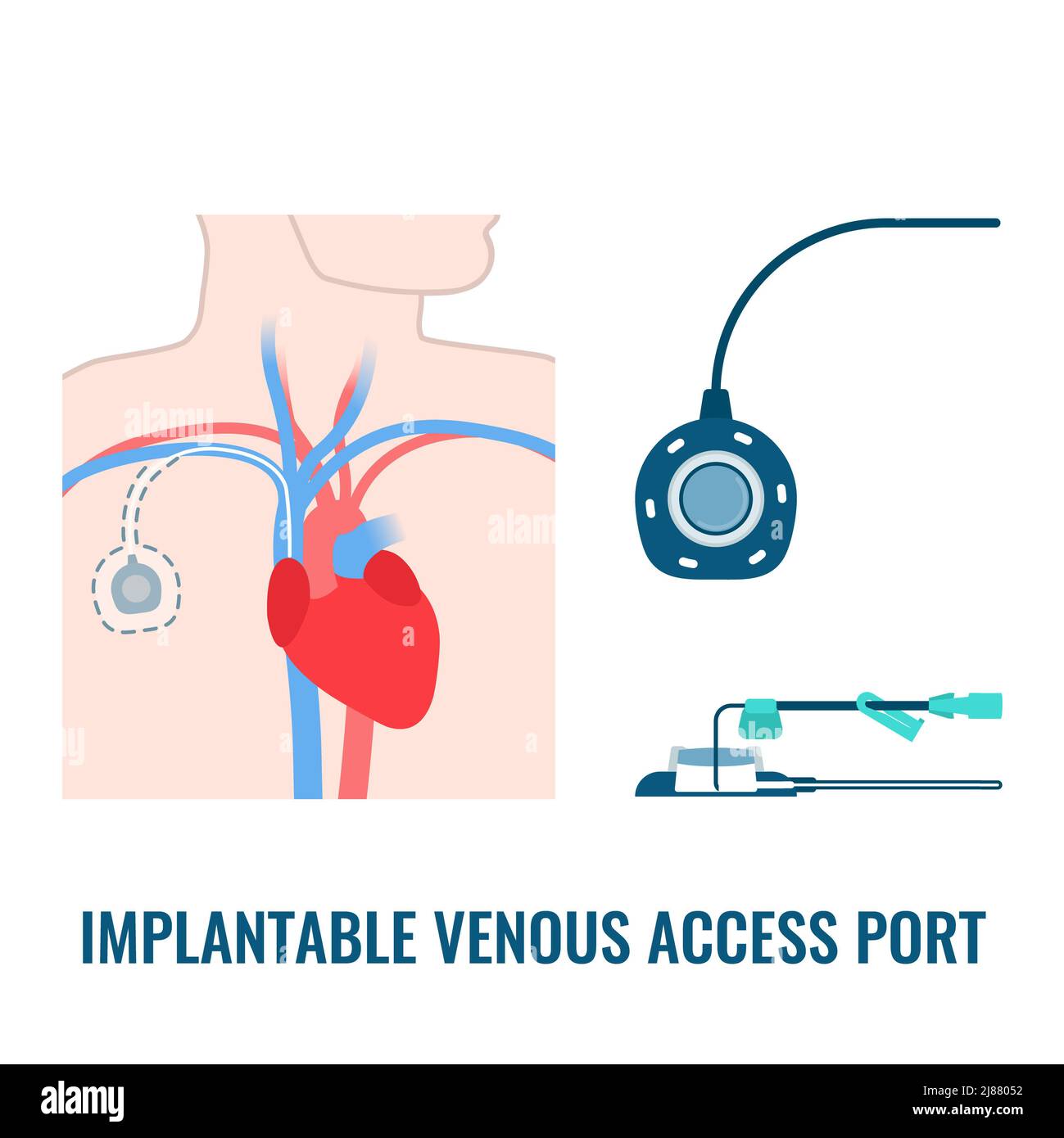 Portacath hi-res stock photography and images - Alamy