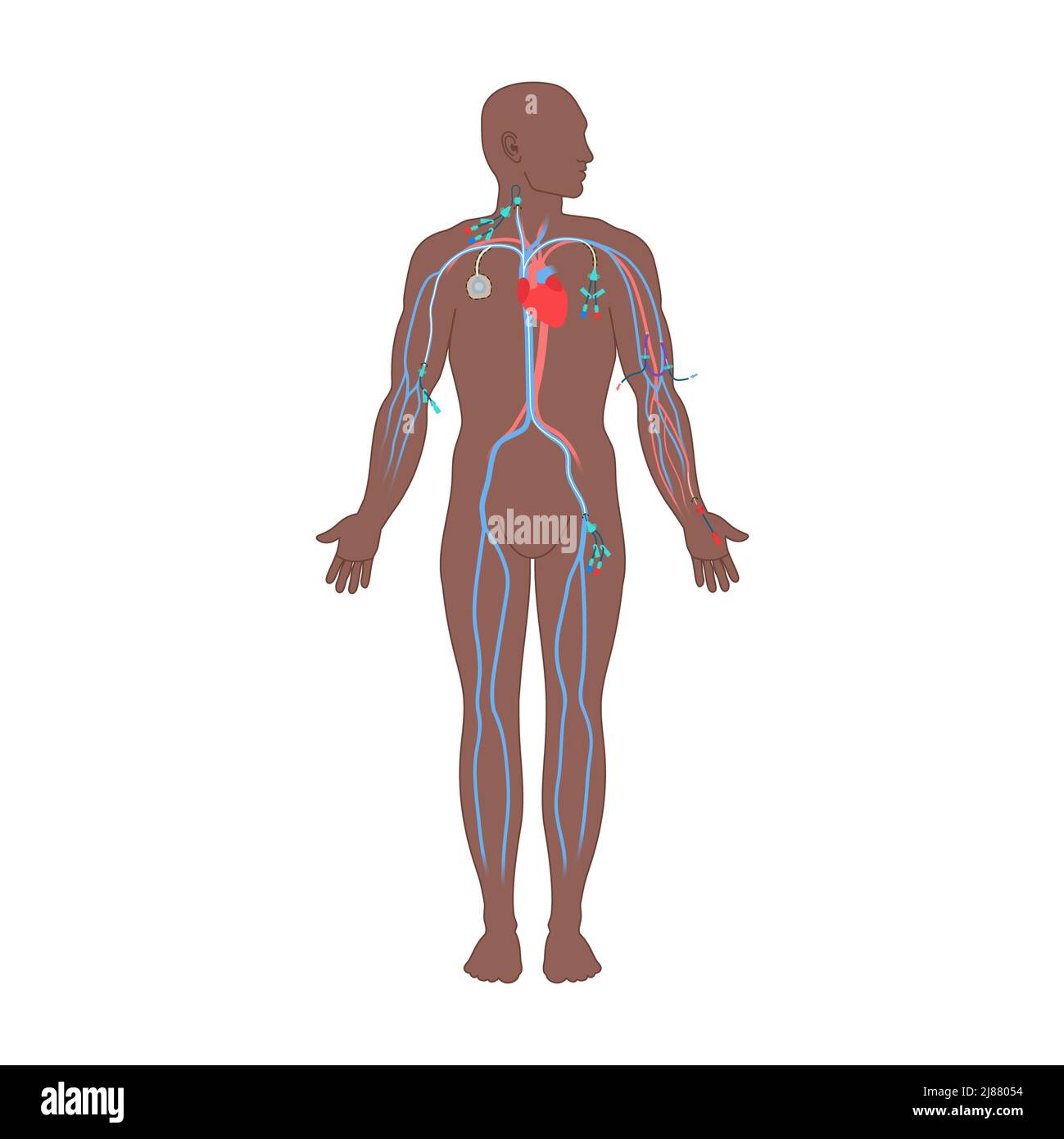 Central venous catheter, illustration Stock Photo - Alamy