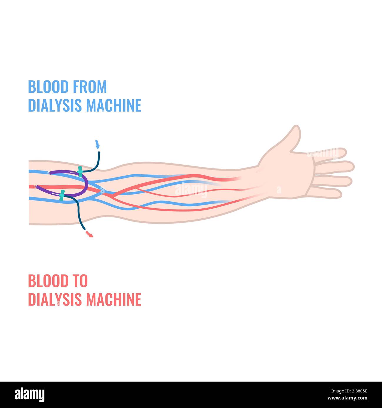 Dialysis shunt graft catheter, illustration Stock Photo - Alamy
