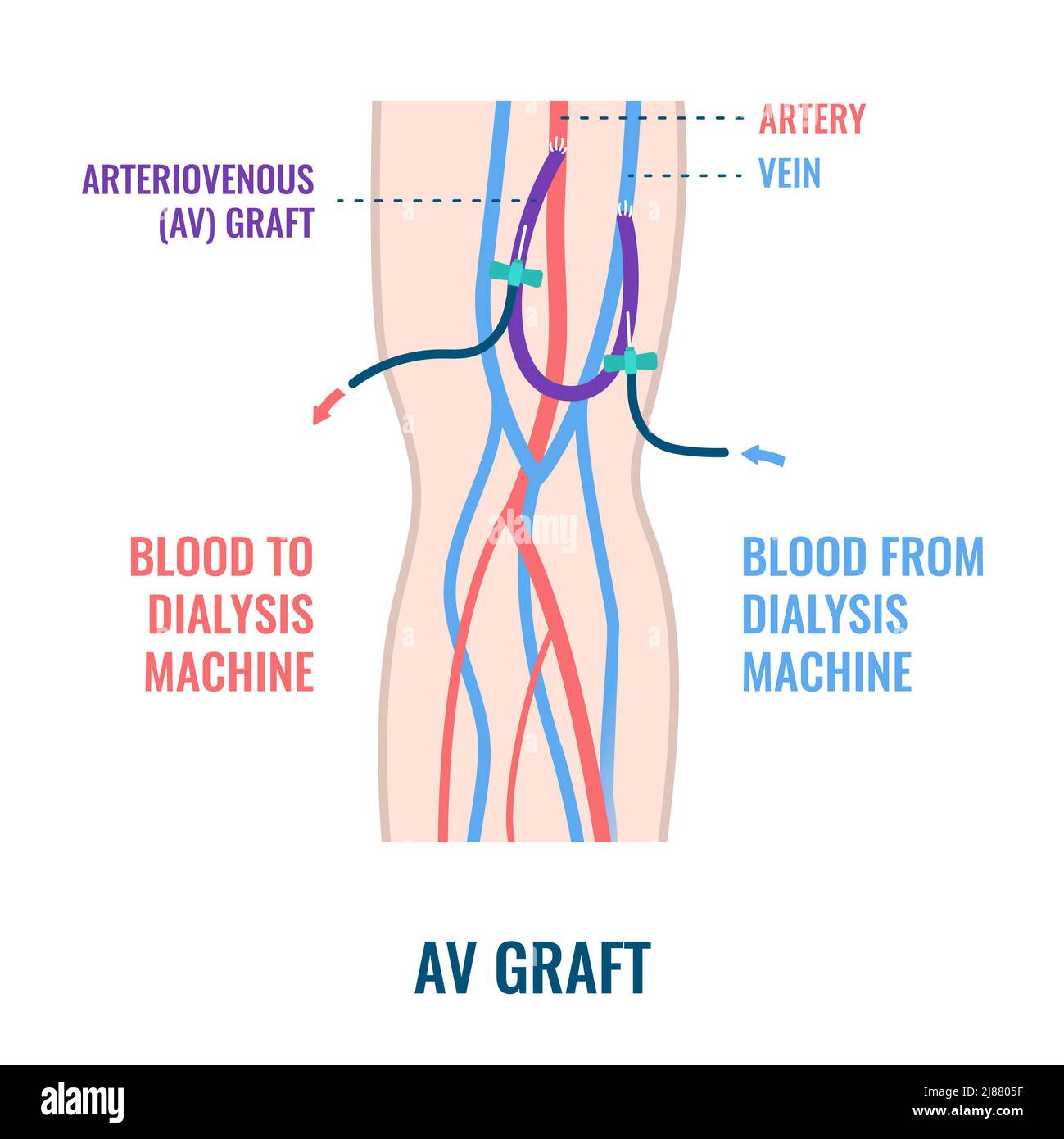 Dialysis shunt graft catheter, illustration Stock Photo - Alamy