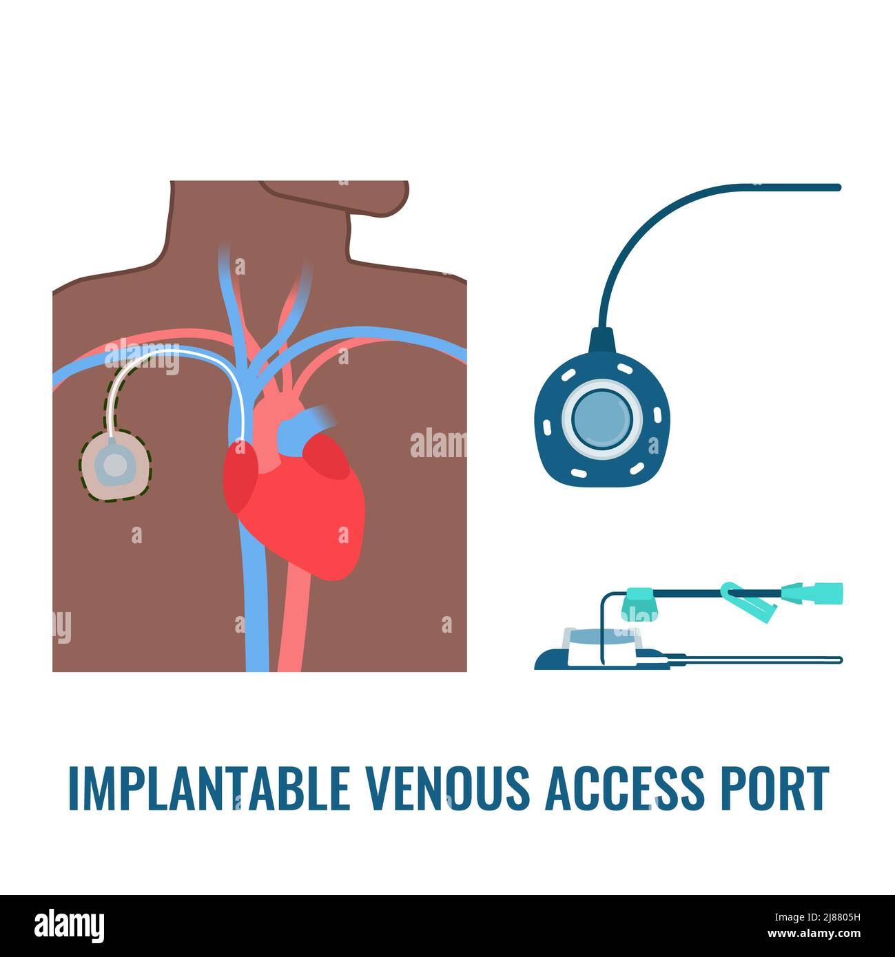 Illustration Of A Totally Implantable Central Venous Catheter Read