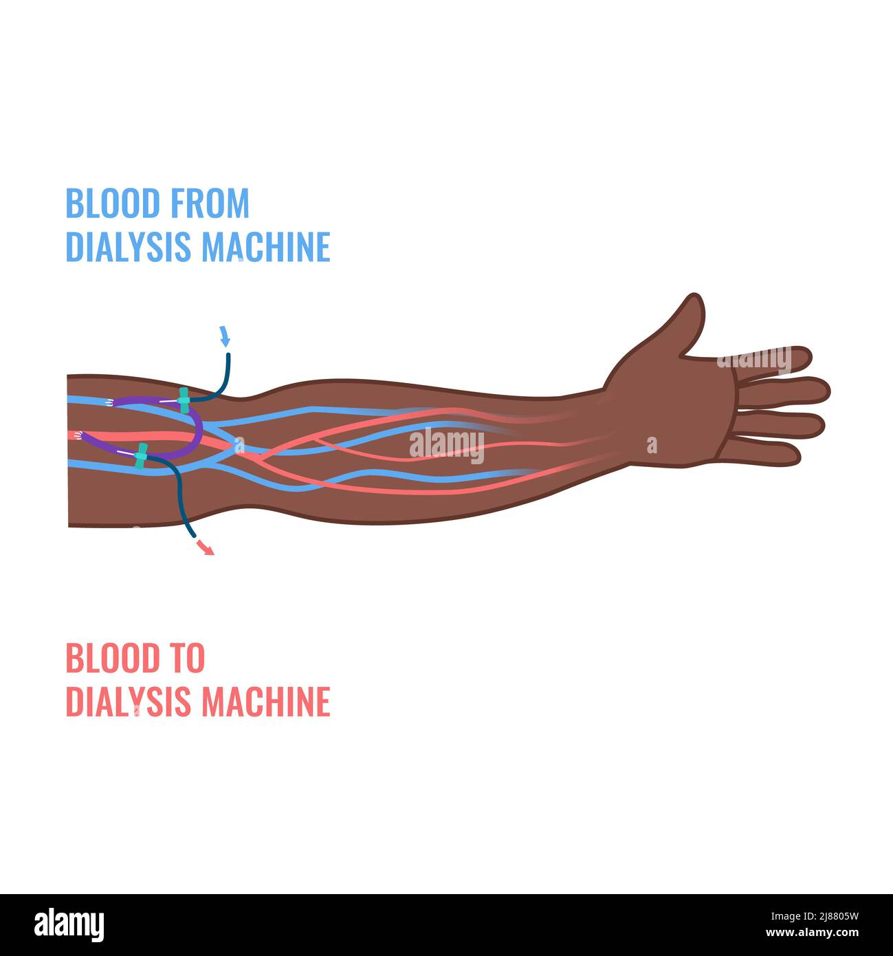 Dialysis shunt graft catheter, illustration Stock Photo - Alamy