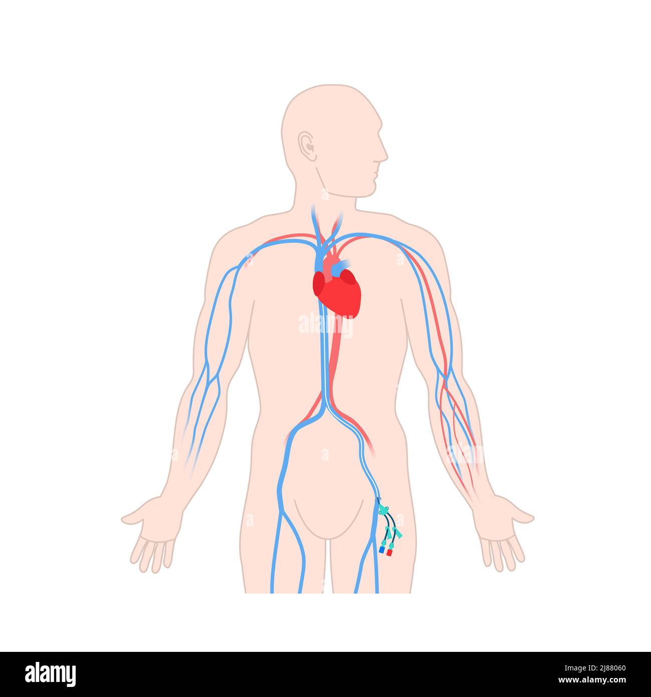 Femoral central venous catheter, illustration Stock Photo - Alamy