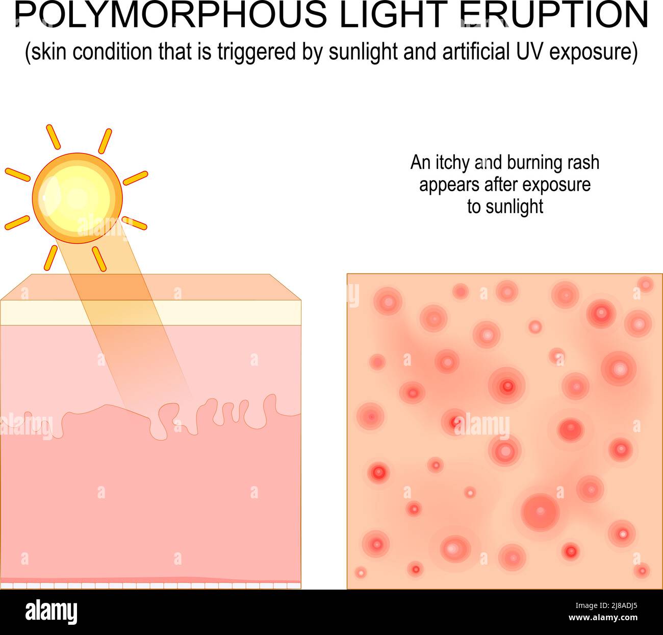Polymorphic Light Eruption An Itchy And Burning Rash Appears After Exposure To Sunlight Close