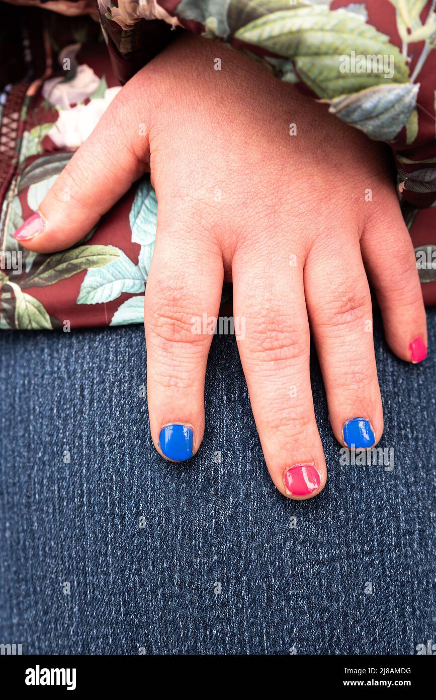 Close up of the small hands of a 39 year old woman with Down Syndrome ...