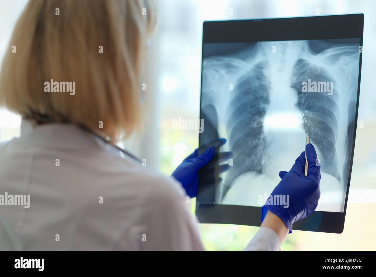 Doctor pointing at damaged area on lung x ray Stock Photo - Alamy