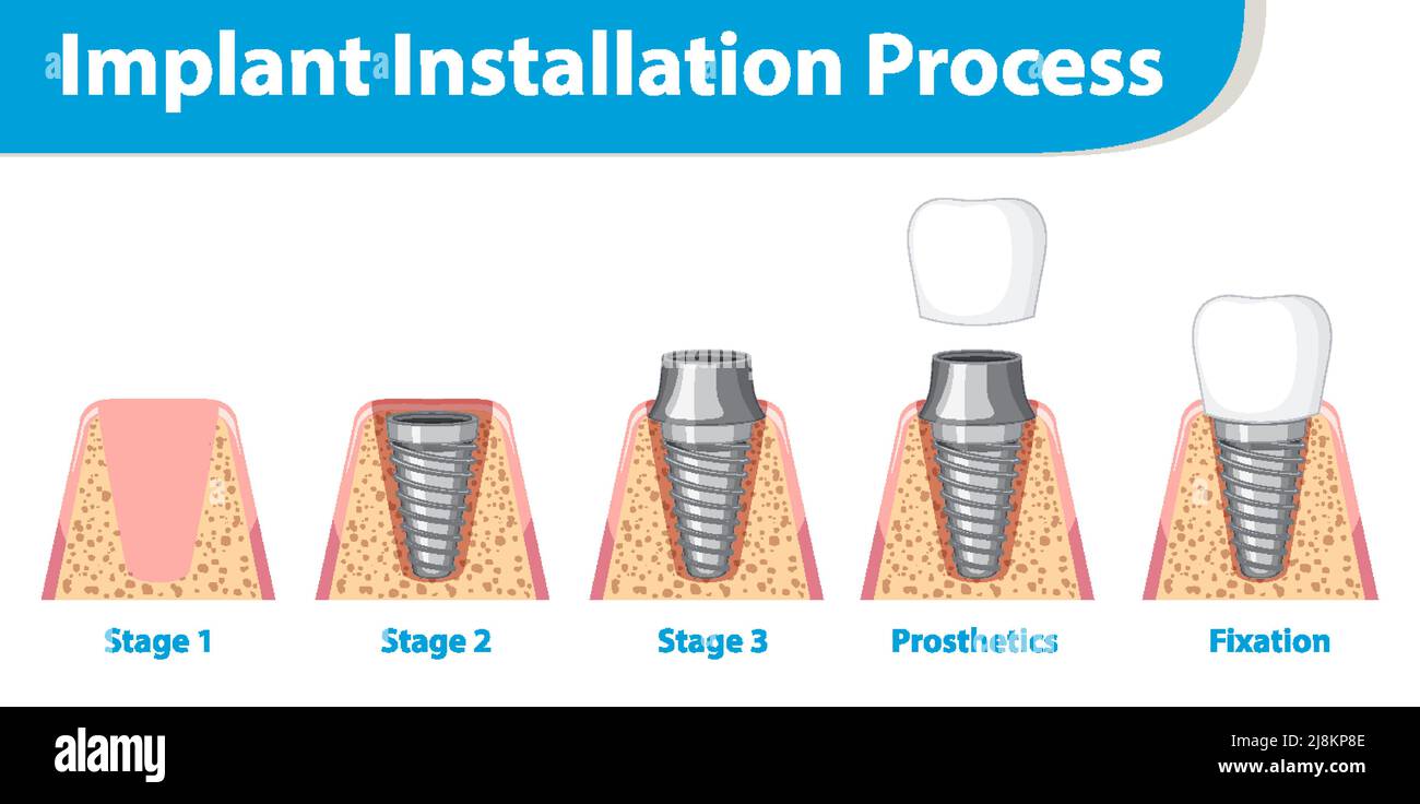 Infographic of human in implant installation process illustration Stock ...