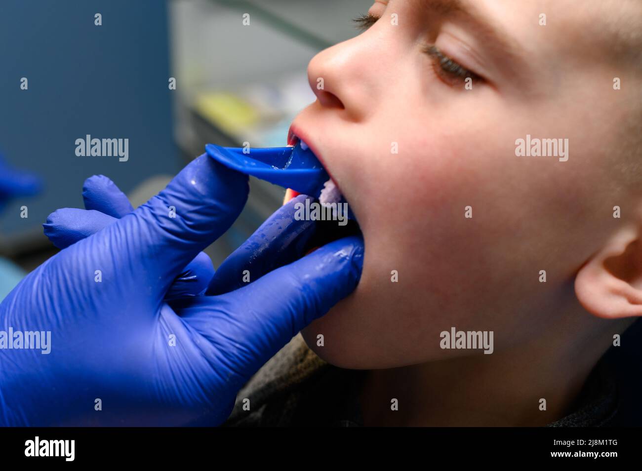 Jaw impression with a silicone diagnostic model, crooked teeth in a ...