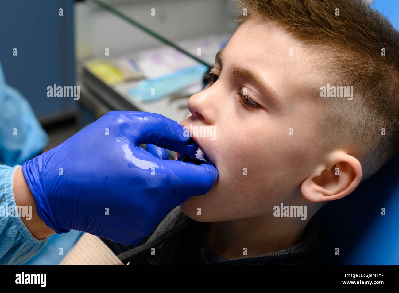 Jaw impression with a silicone diagnostic model, crooked teeth in a ...