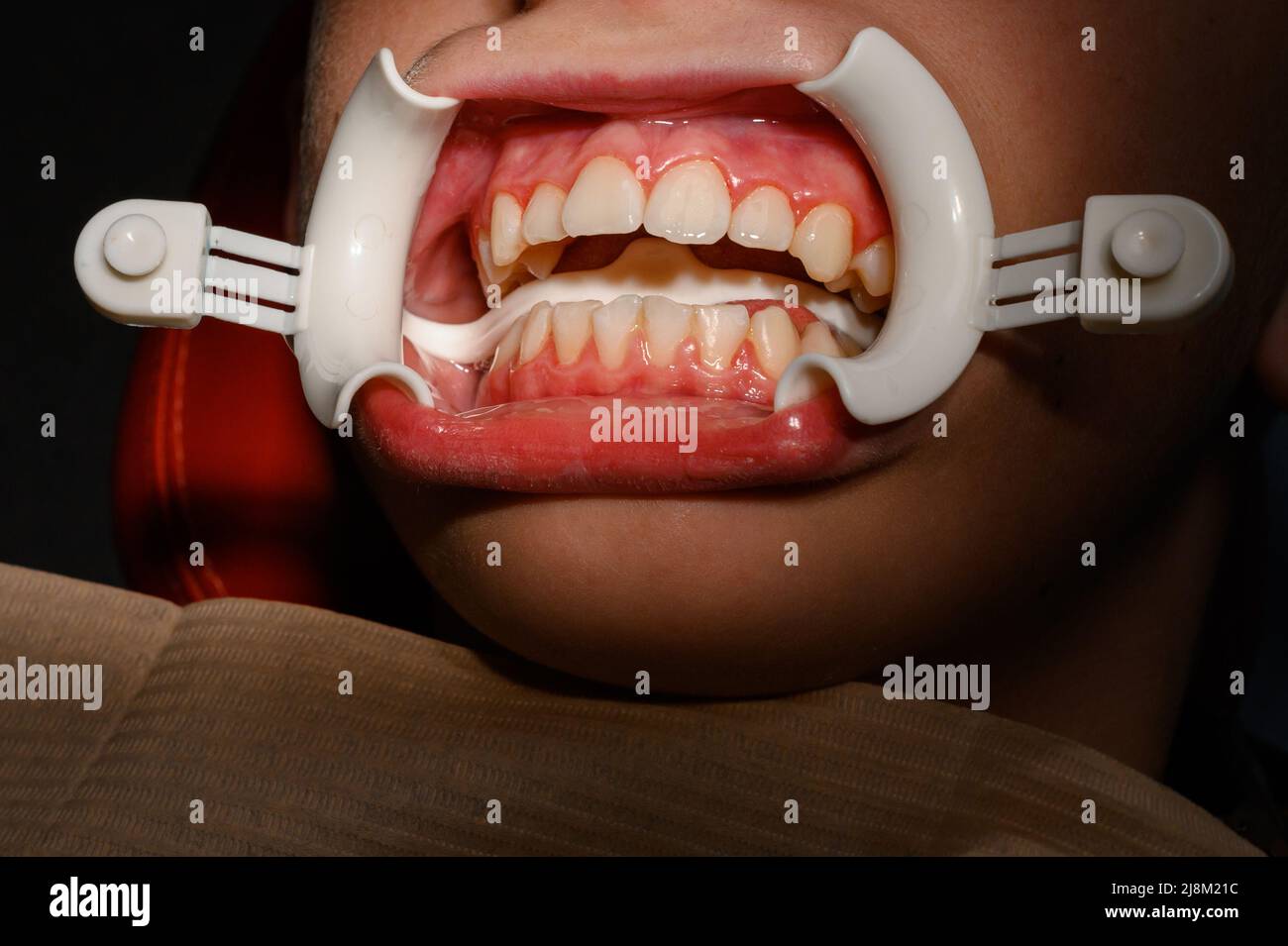 Plastic retractor for lip augmentation in the mouth, dental procedure ...