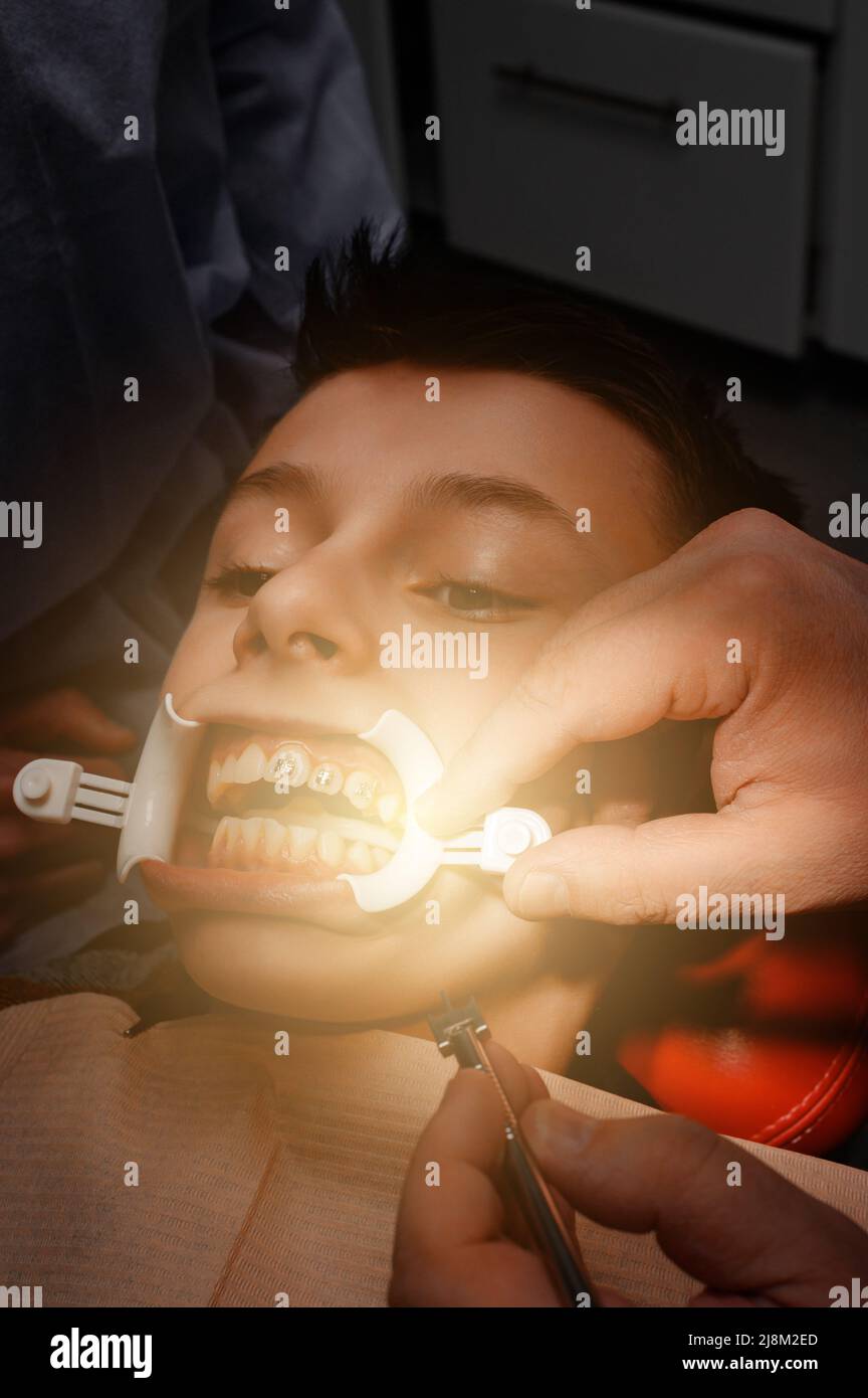 Close up of installing braces on teeth, aligning teeth with braces ...