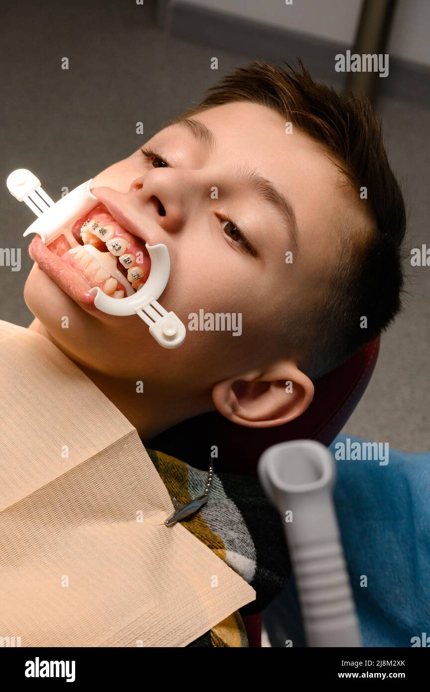 Visit to the orthodontist, installation of braces on the upper teeth ...