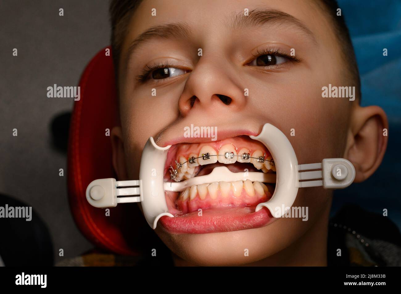 Visit to the orthodontist, installation of braces on the upper teeth ...