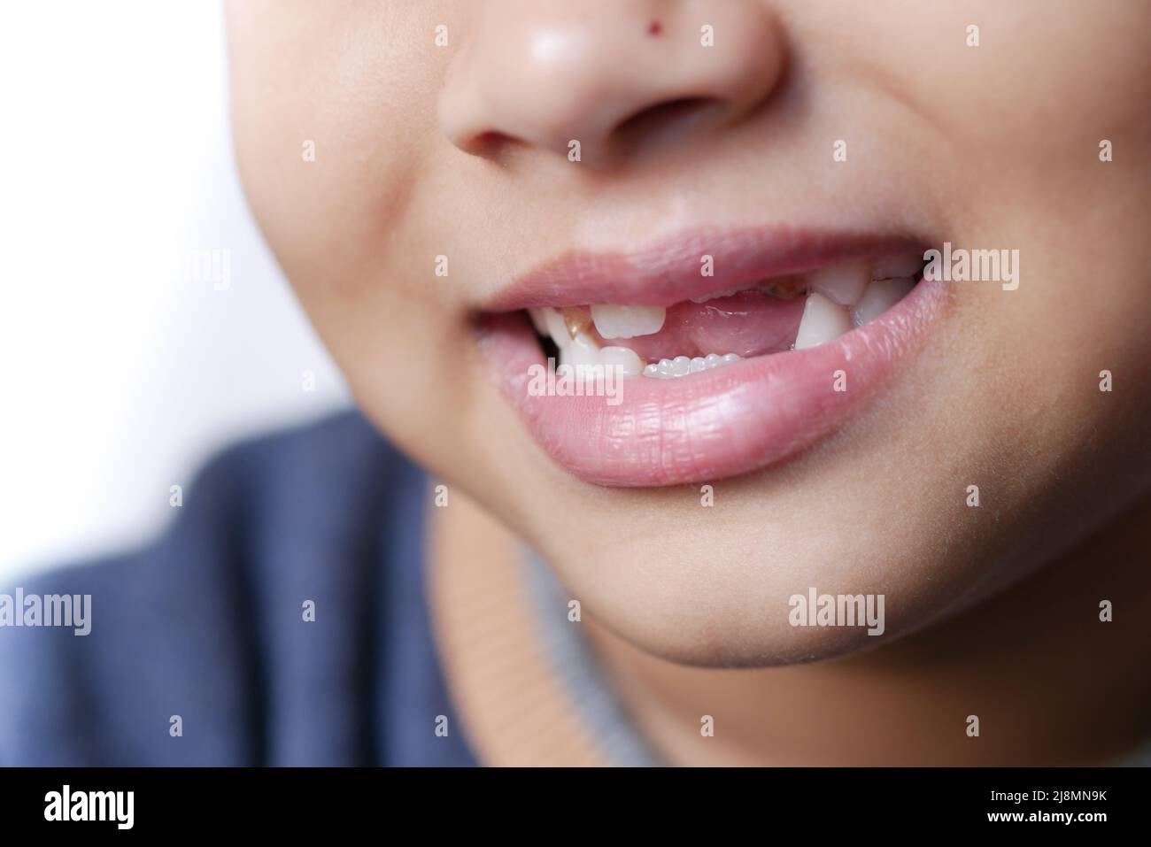 Deformed Human Teeth