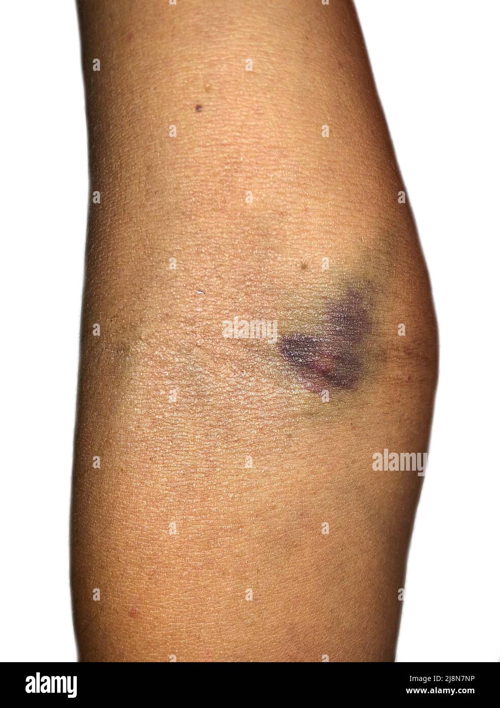Bruises at elbow of Asian female patient. Intravenous needle injury ...