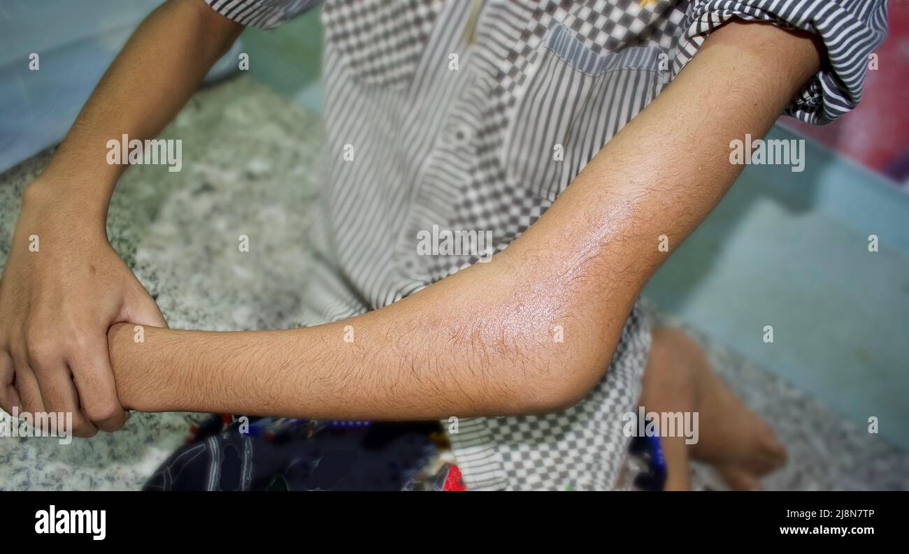 Humerus fracture hi-res stock photography and images - Alamy