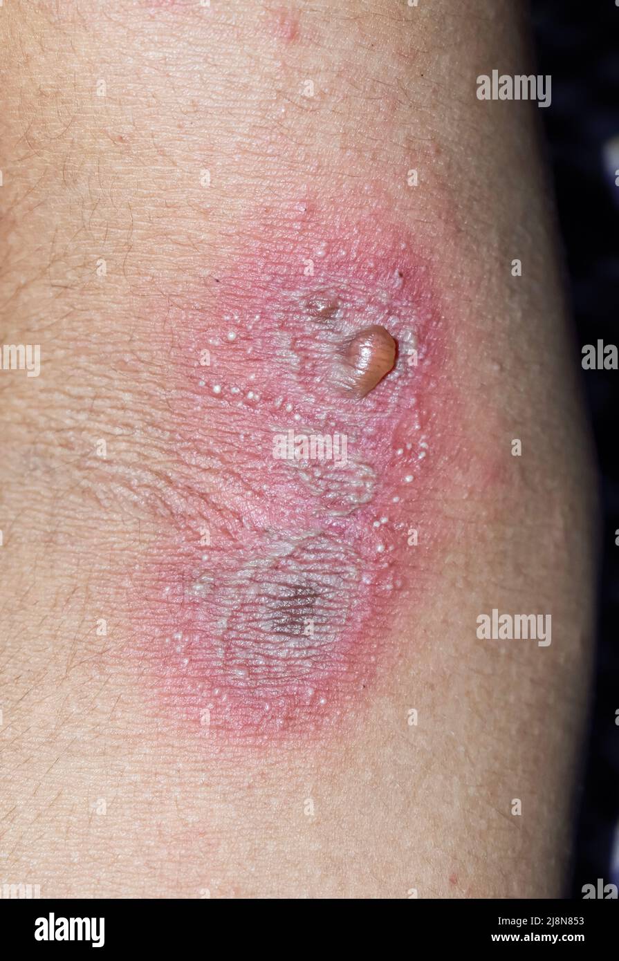 Rove Beetle Dermatitis