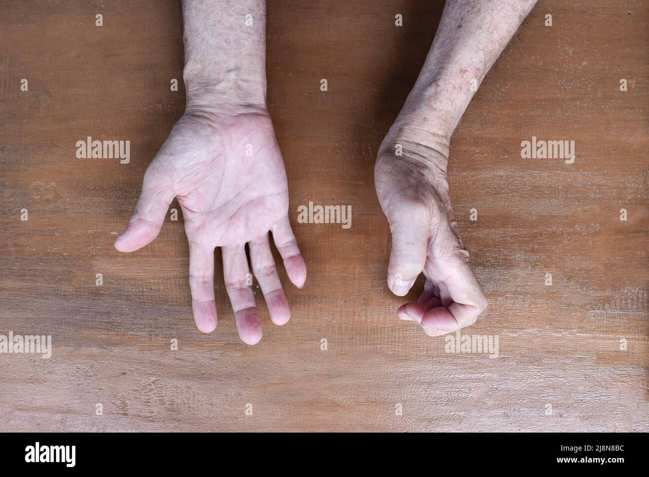 Volkmann contracture in left upper limb of Southeast Asian elder man ...