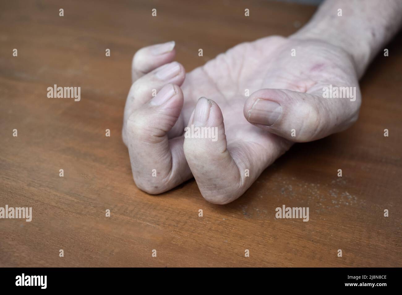 Volkmann contracture in left upper limb of Southeast Asian elder man ...