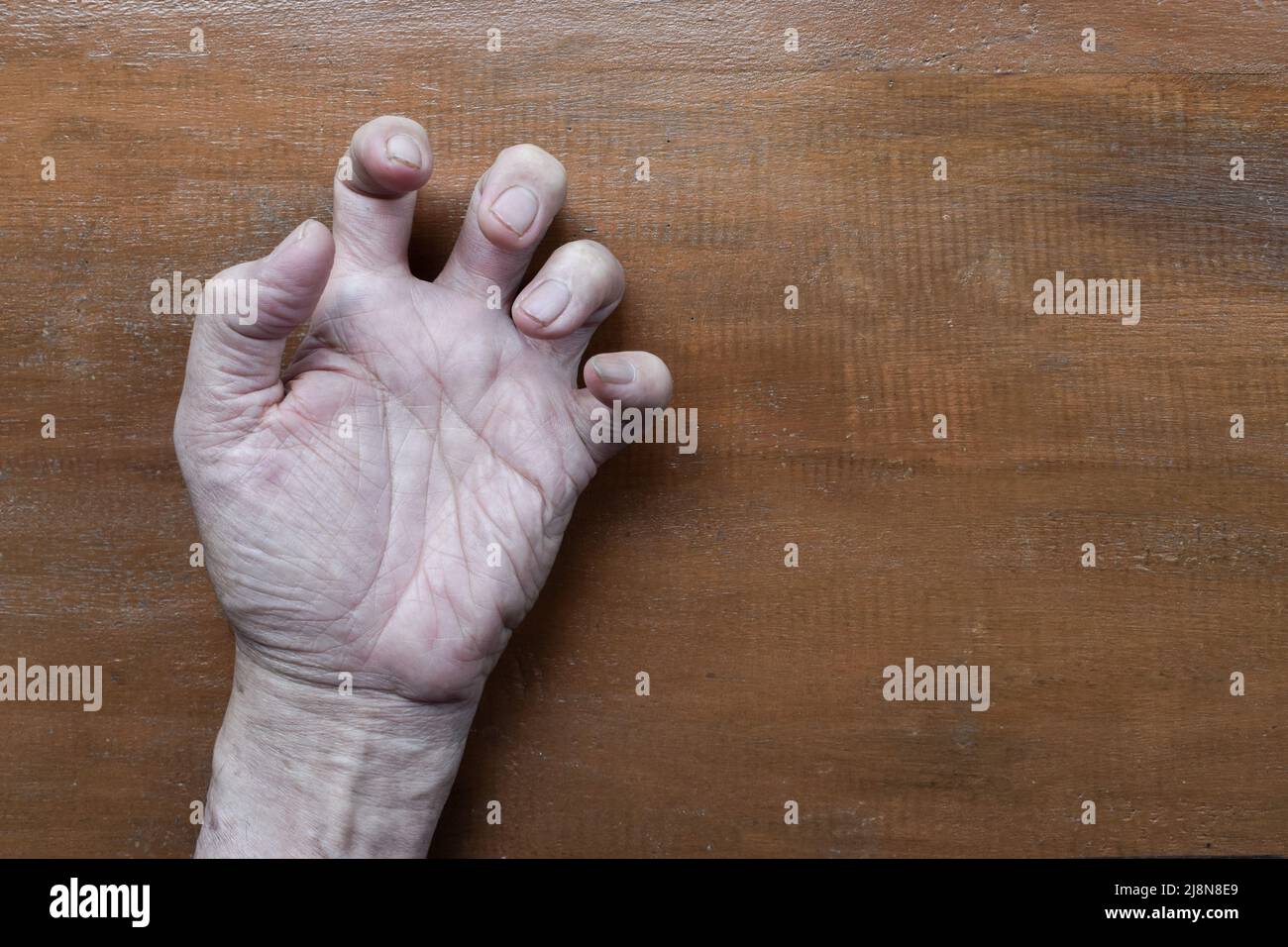 Volkmann contracture in left upper limb of Southeast Asian elder man ...