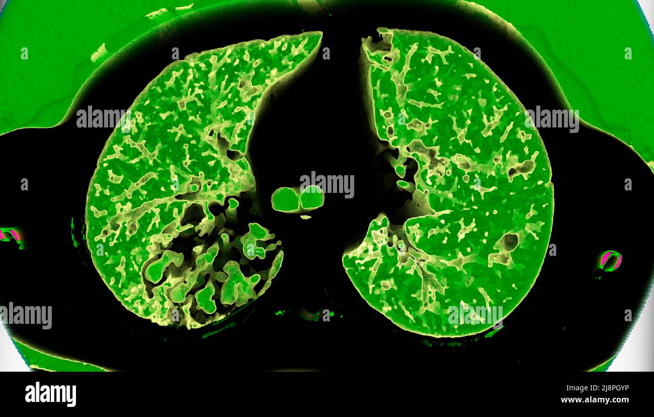 Bronchiectasis, 3D CT scan Stock Photo - Alamy