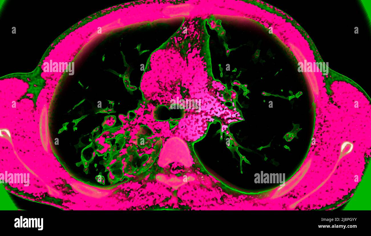 Bronchiectasis, 3D CT scan Stock Photo - Alamy