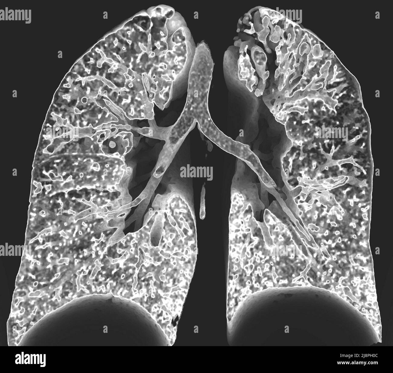 Bronchiectasis, 3D CT scan Stock Photo - Alamy