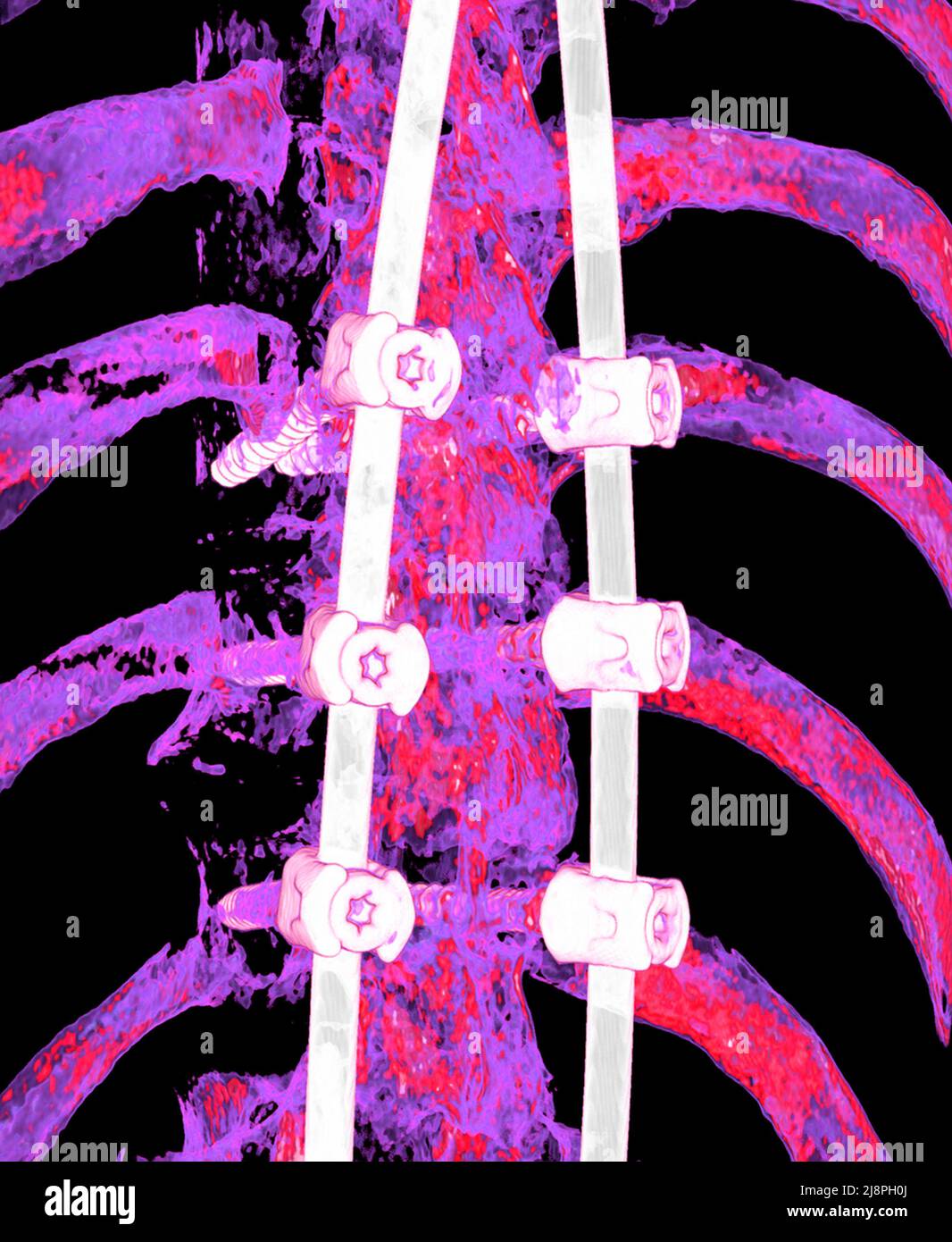 Pinned spine, 3D CT scan Stock Photo - Alamy