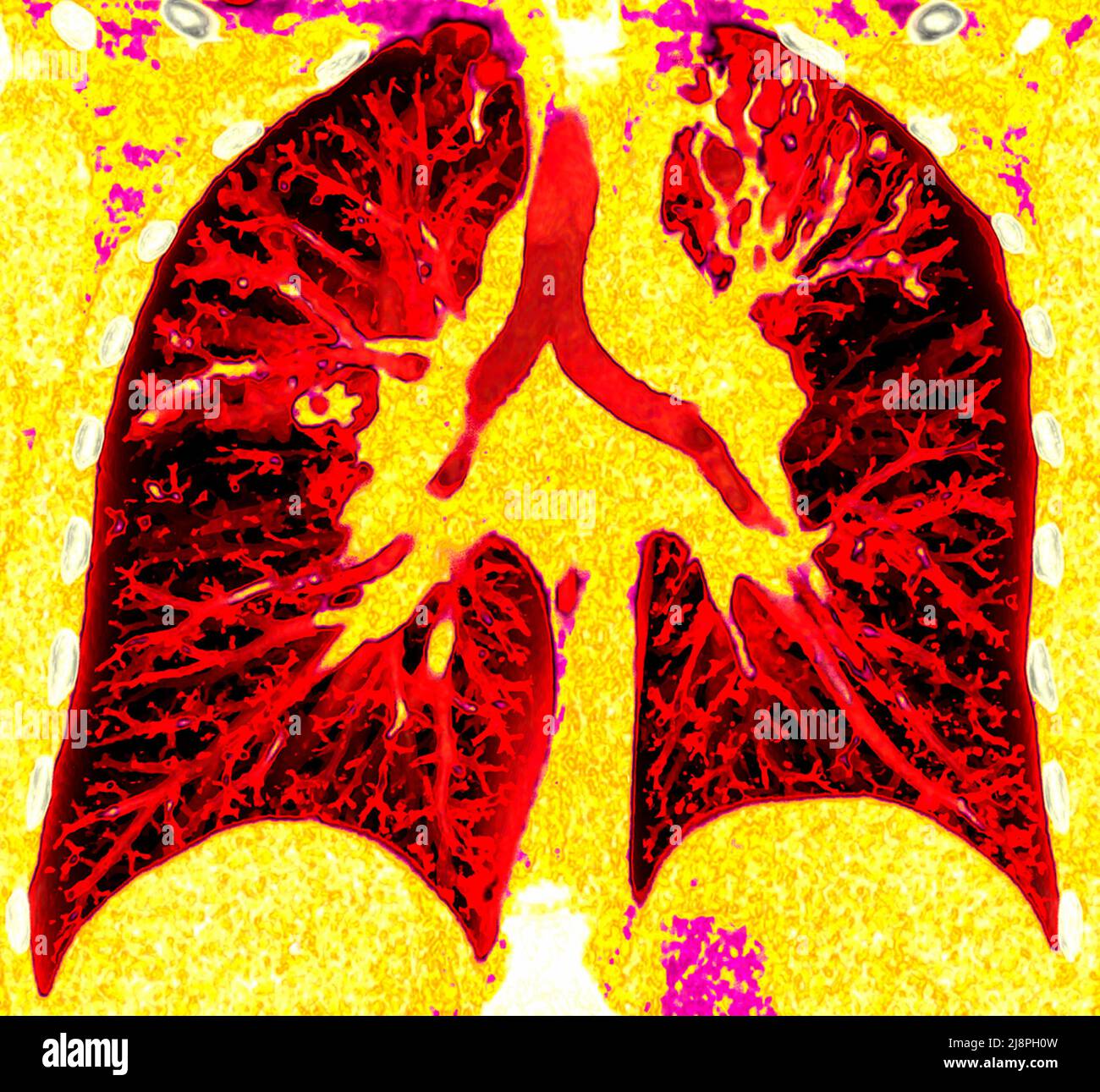 Bronchiectasis, 3D CT scan Stock Photo - Alamy