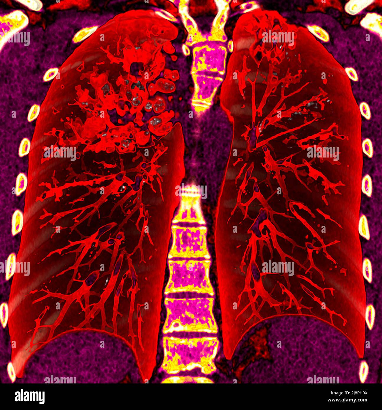 Bronchiectasis, 3D CT scan Stock Photo - Alamy