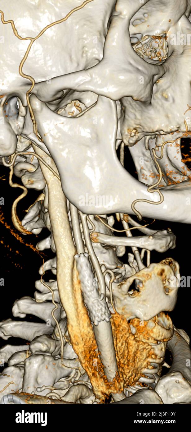 Arterial stent, 3D CT scan Stock Photo - Alamy