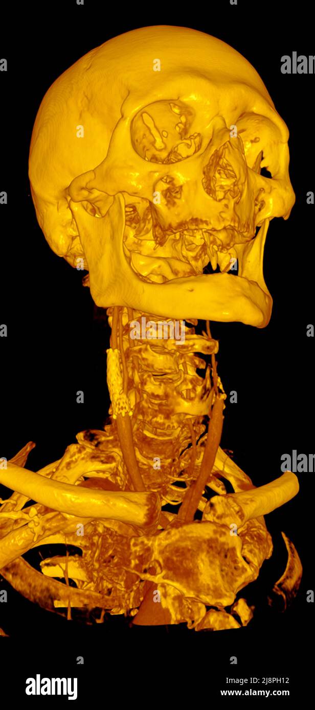 Arterial stent, 3D CT scan Stock Photo - Alamy