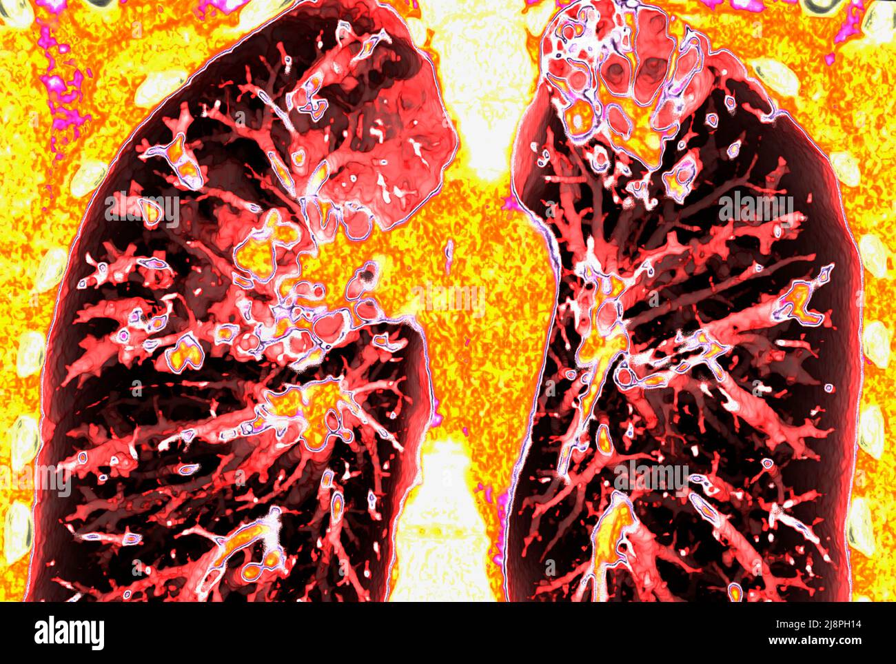 Bronchiectasis, 3D CT scan Stock Photo - Alamy