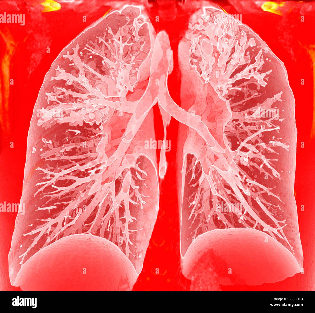 Bronchiectasis, 3D CT scan Stock Photo - Alamy