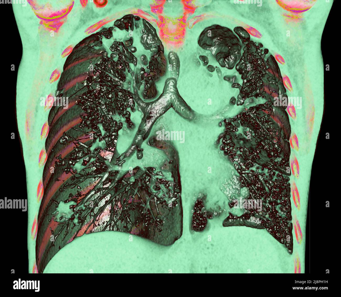 Tuberculosis, 3D CT scan Stock Photo - Alamy