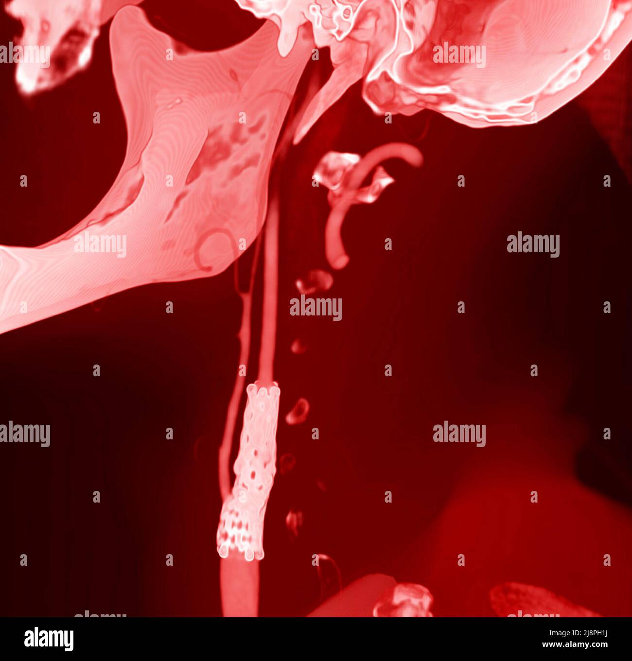 Arterial stent, CT scan Stock Photo - Alamy