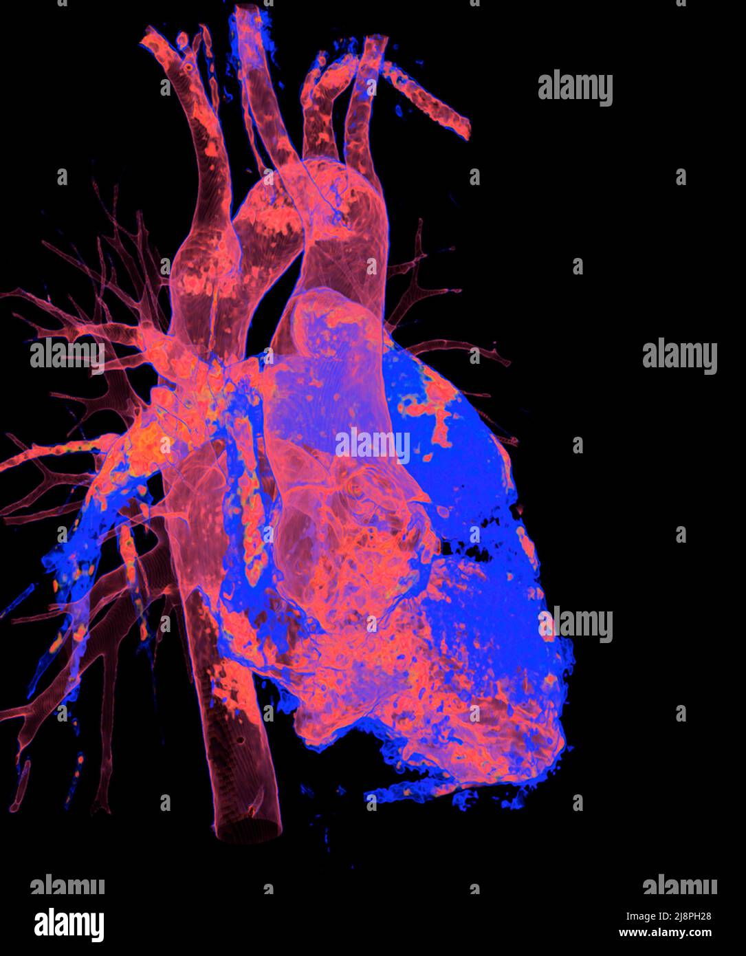 Kommerell diverticulum, 3D CT scan Stock Photo - Alamy