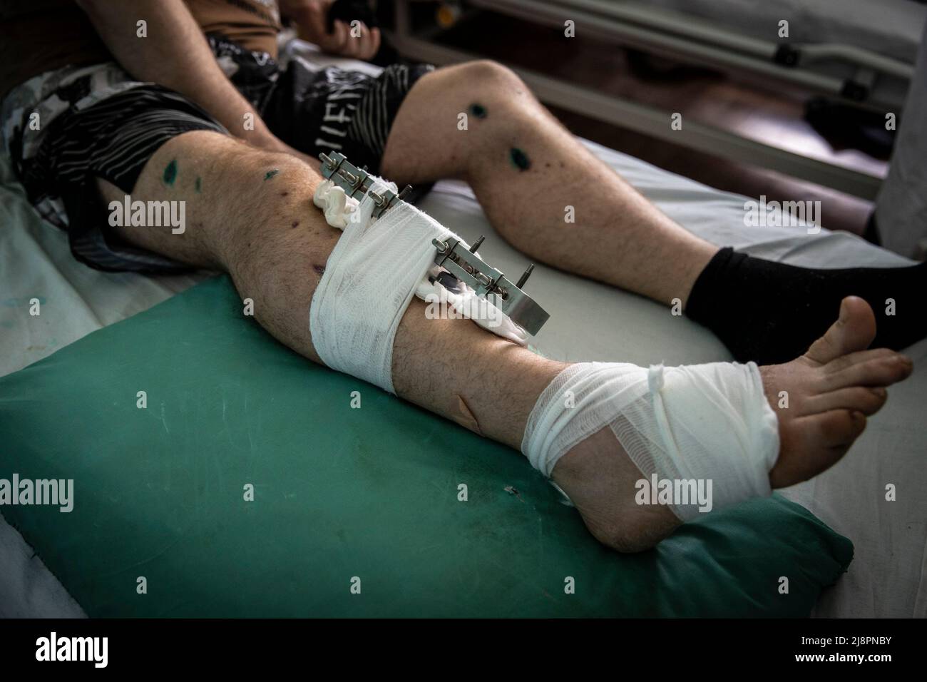 Ukrainian Soldier Sergei (38) shows his injuries on his right leg as he ...